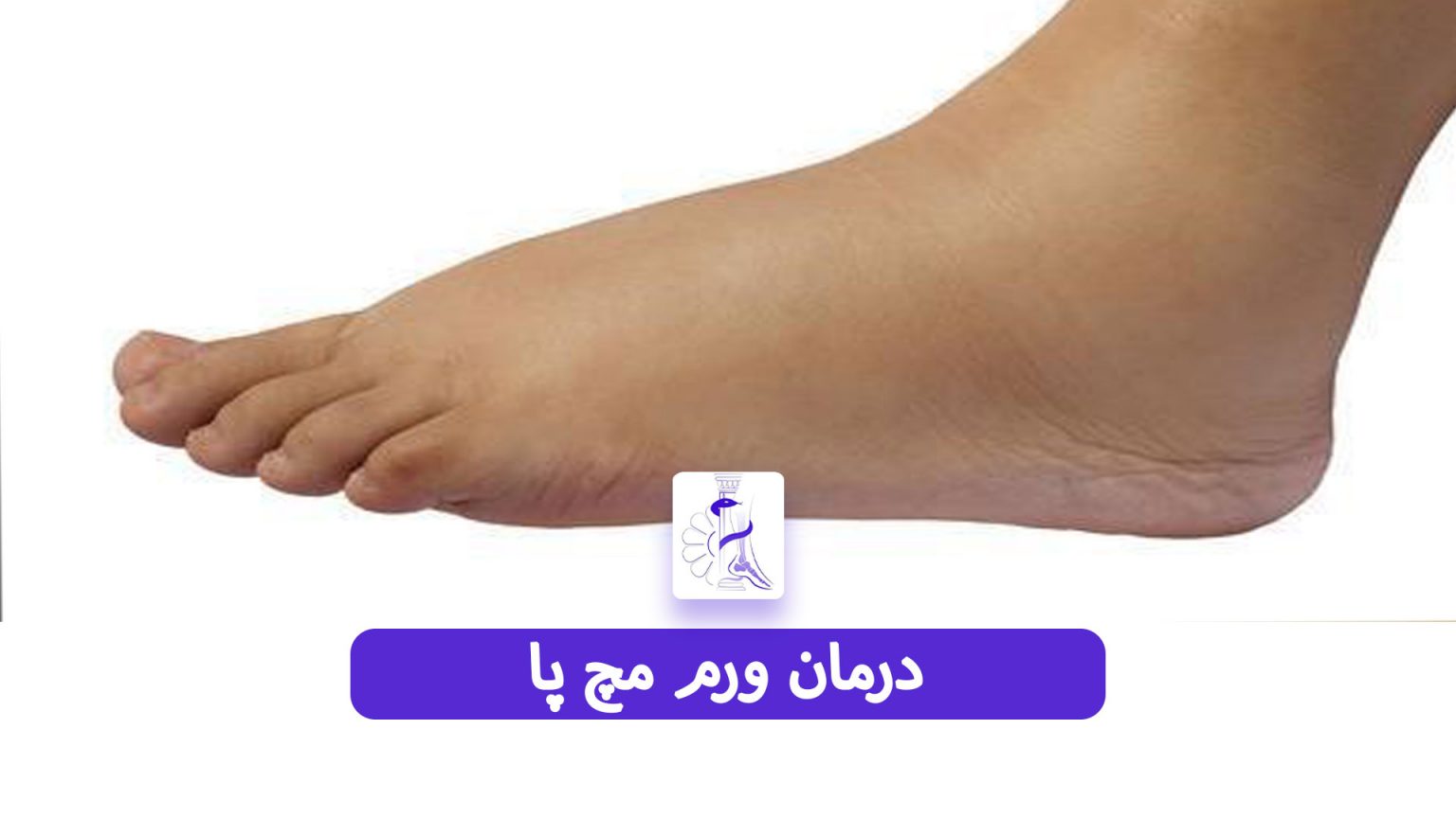 درمان ورم مچ پا متخصص ارتوپدی در شیراز 